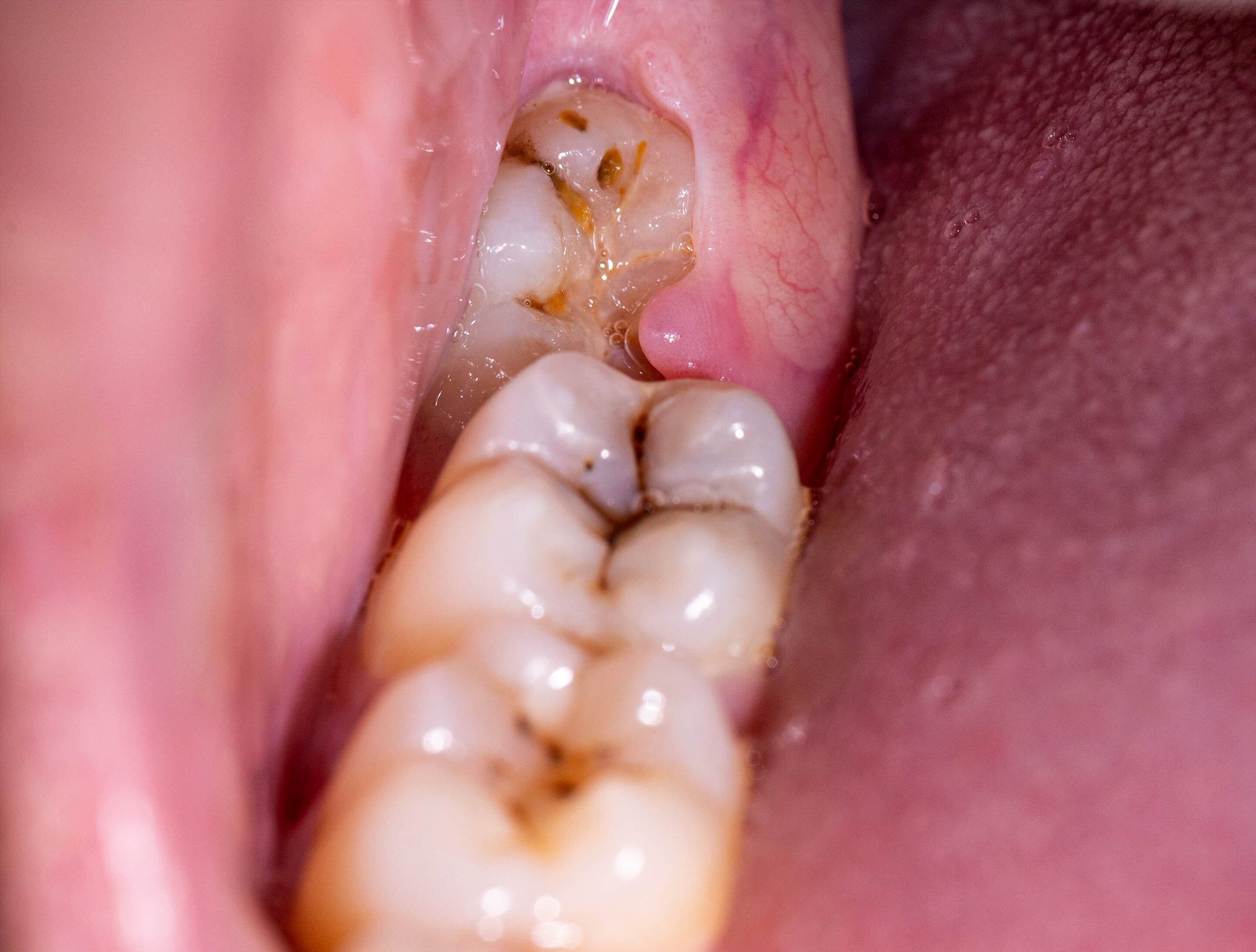 Why do we have wisdom teeth? Should they be pulled out? Your questions ...