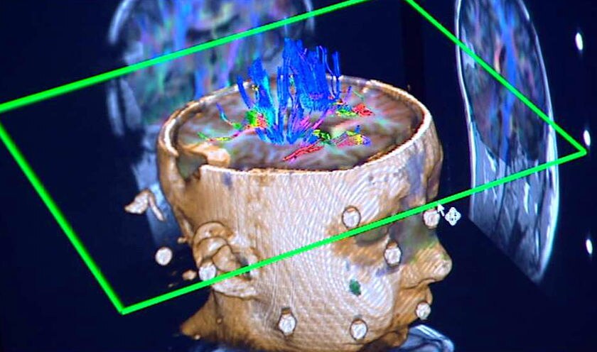 Mild brain trauma victims at risk of mental health problems ...