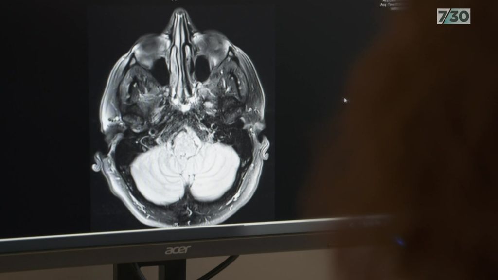 New developments in the treatment of migraines - ABC News