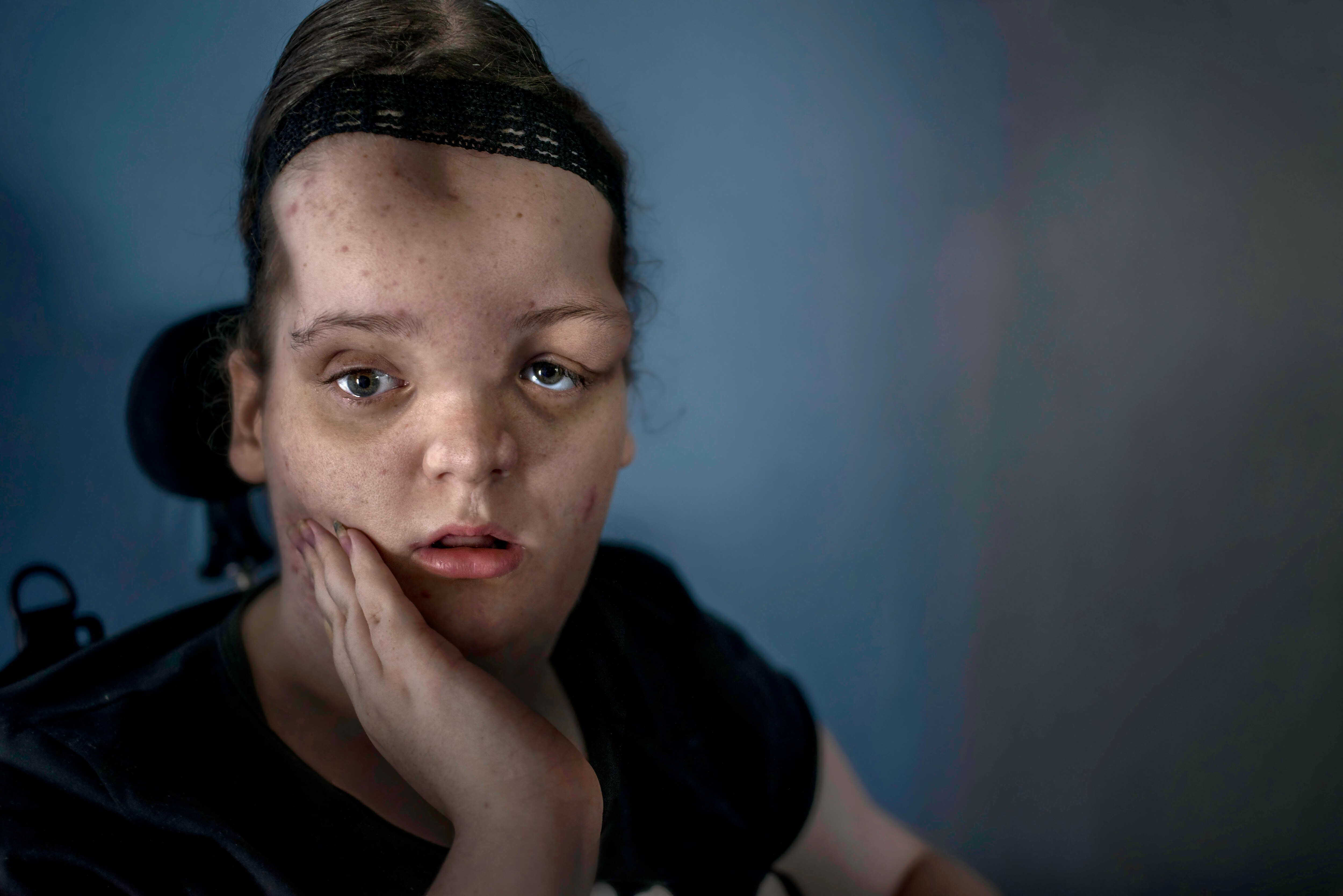 Teenager with rare syndrome hopes medical trial may slow growth of ...