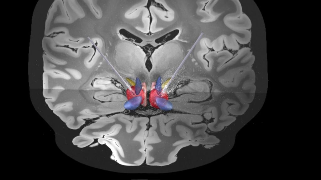 Electrodes in the brain - ABC News