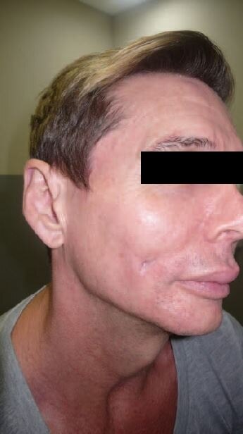 'My face became infected again and again': Australians at risk of ...