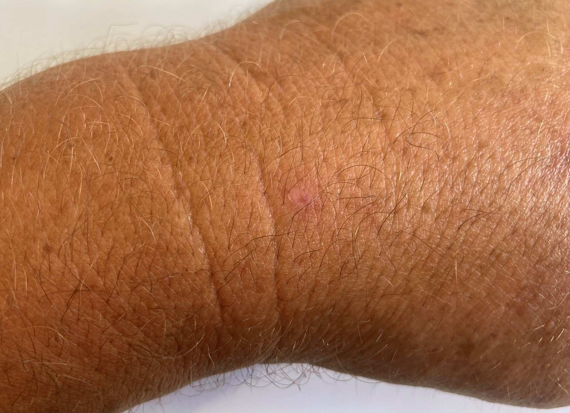 Canberra man does DIY surgery after waiting years for medical help ...