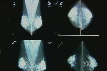 HRT warnings repeated after ovarian cancer study - ABC News