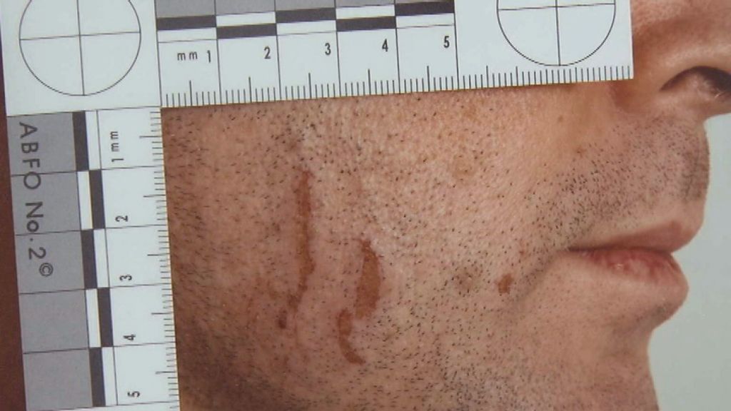 Scratch marks on accused killer's face 'typical of fingernail scratches ...