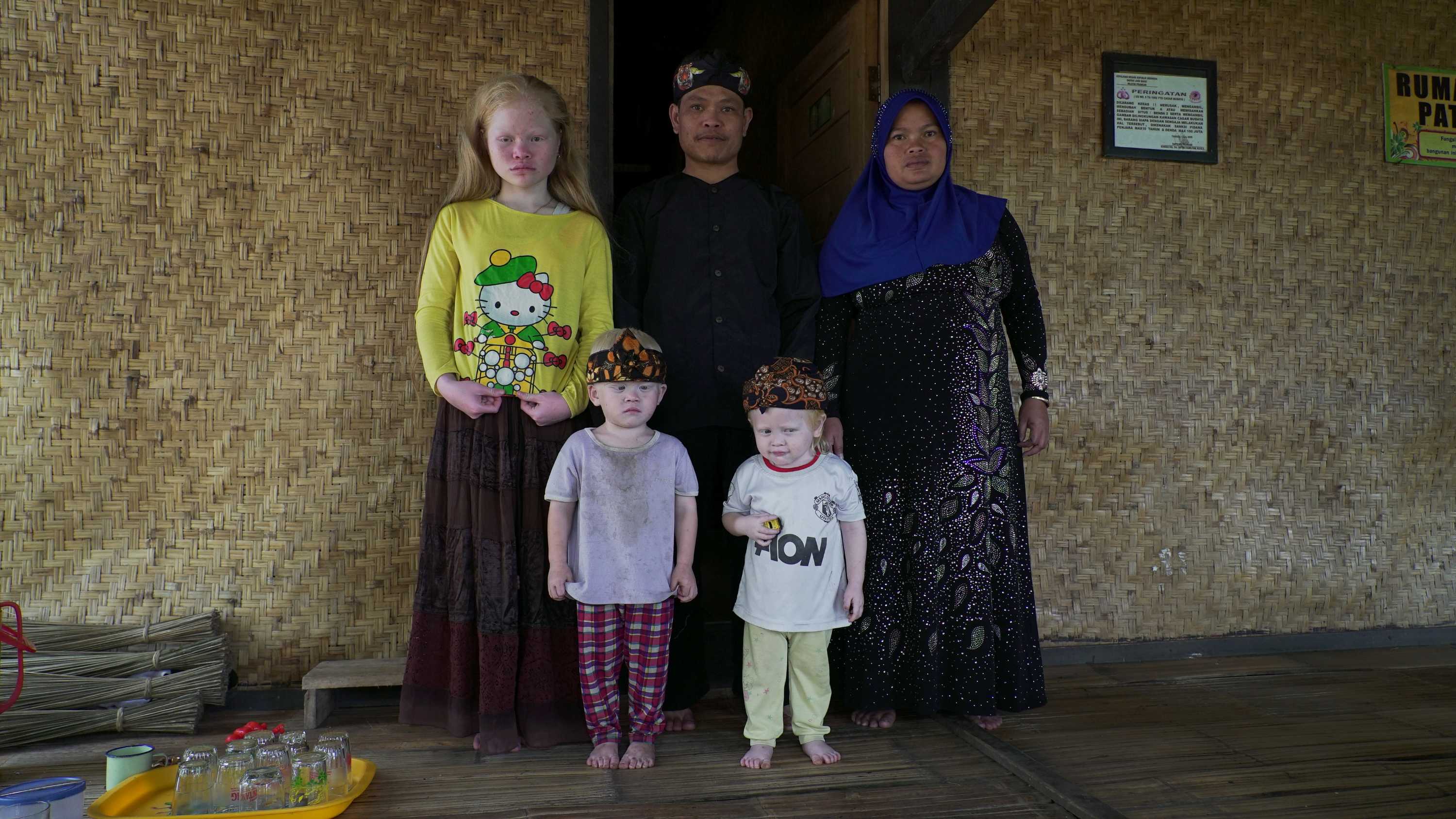 Kisah 'Walanda Sunda' di Kampung Albino Ciburuy - ABC News