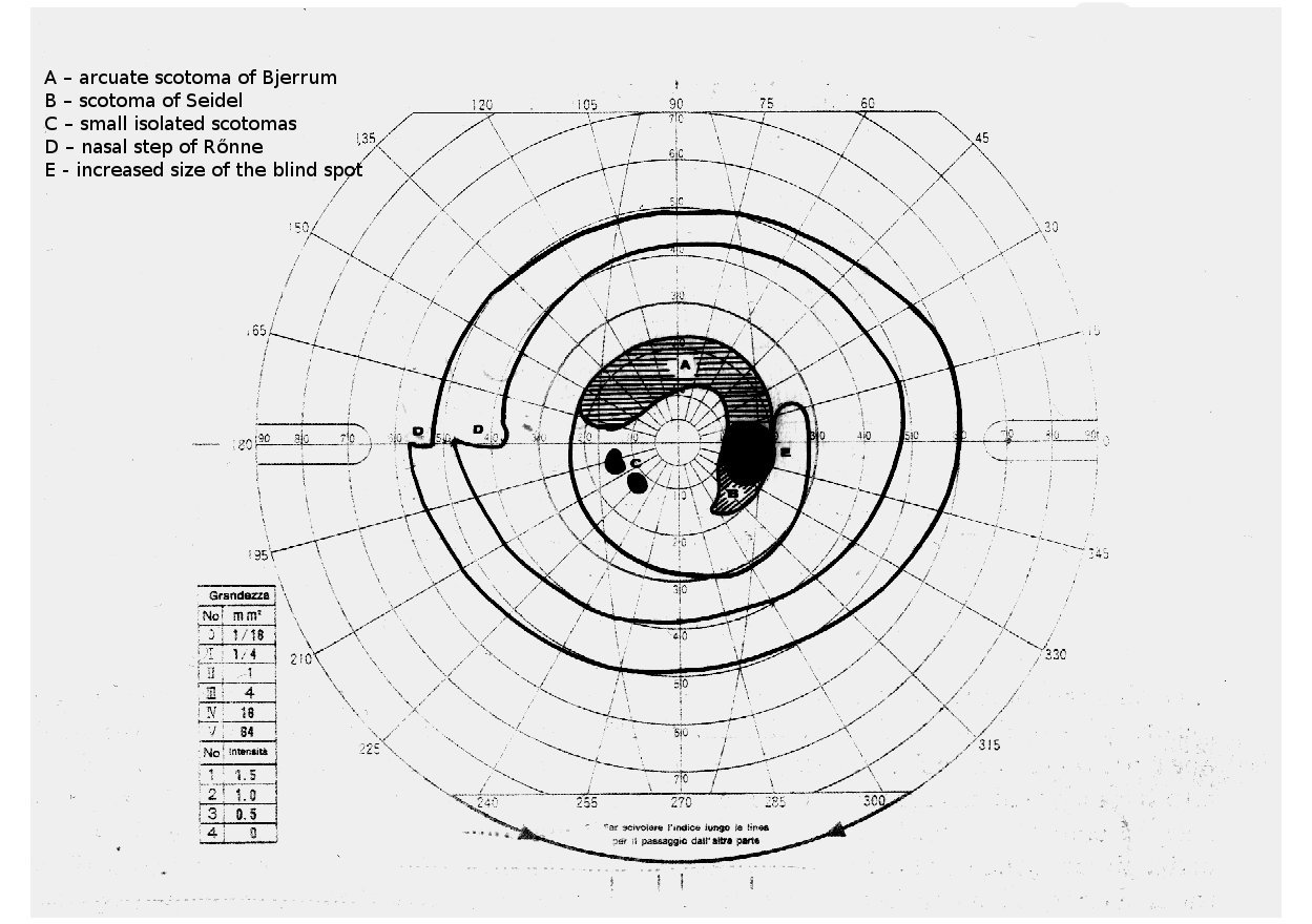Shannon's incredible story with his "stolen" eyesight - ABC listen