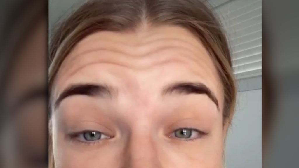 Laura Meadows films Botox kicking in - ABC News