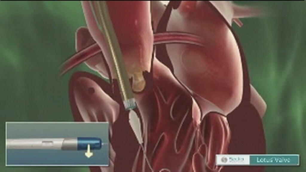 Melbourne surgeons in heart valve breakthrough - ABC News