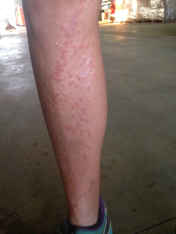 Mango rash cases at Katherine Hospital down this season - ABC News