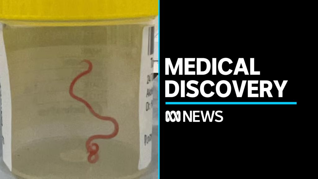 Living roundworm pulled from brain of patient in world-first discovery ...