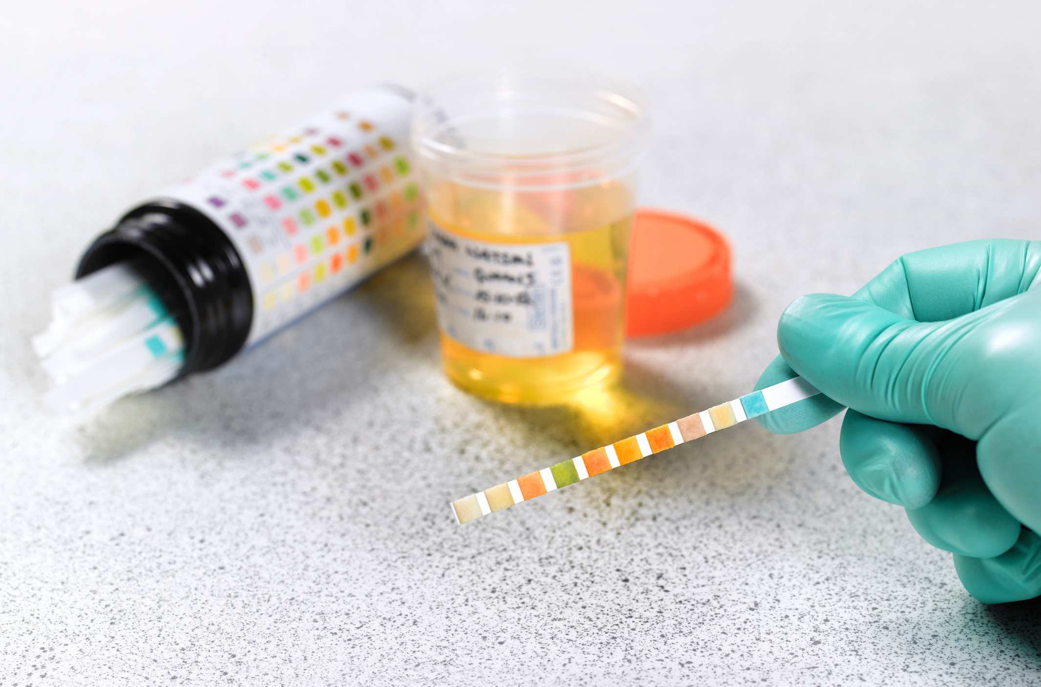 Urinary tract infections: How they're prevented, diagnosed and treated ...