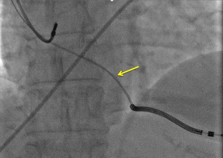 Pacemaker-defibrillator device shocks patient 60 times, but ...