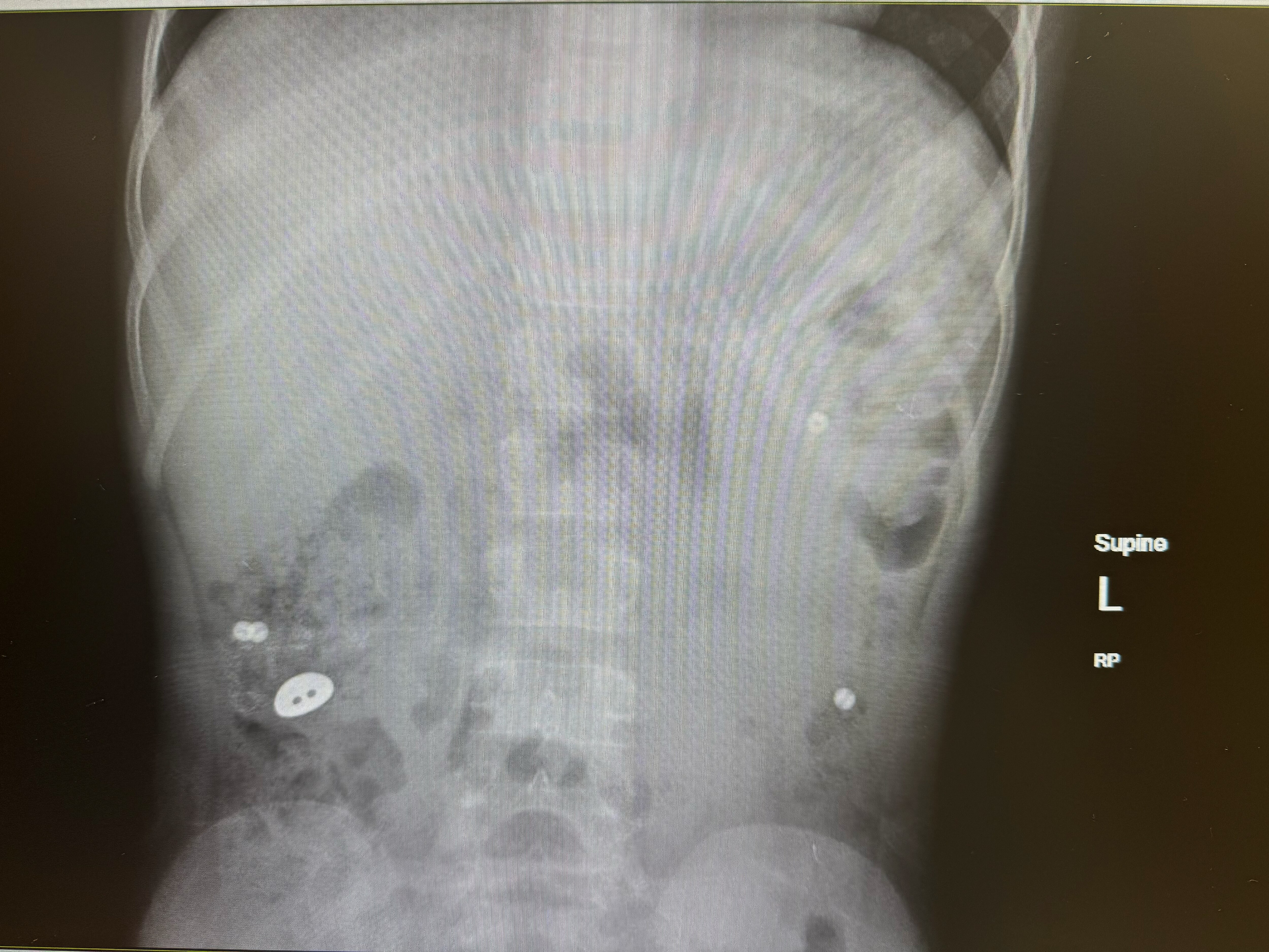 The top 10 things children get stuck up their nose, according to ...