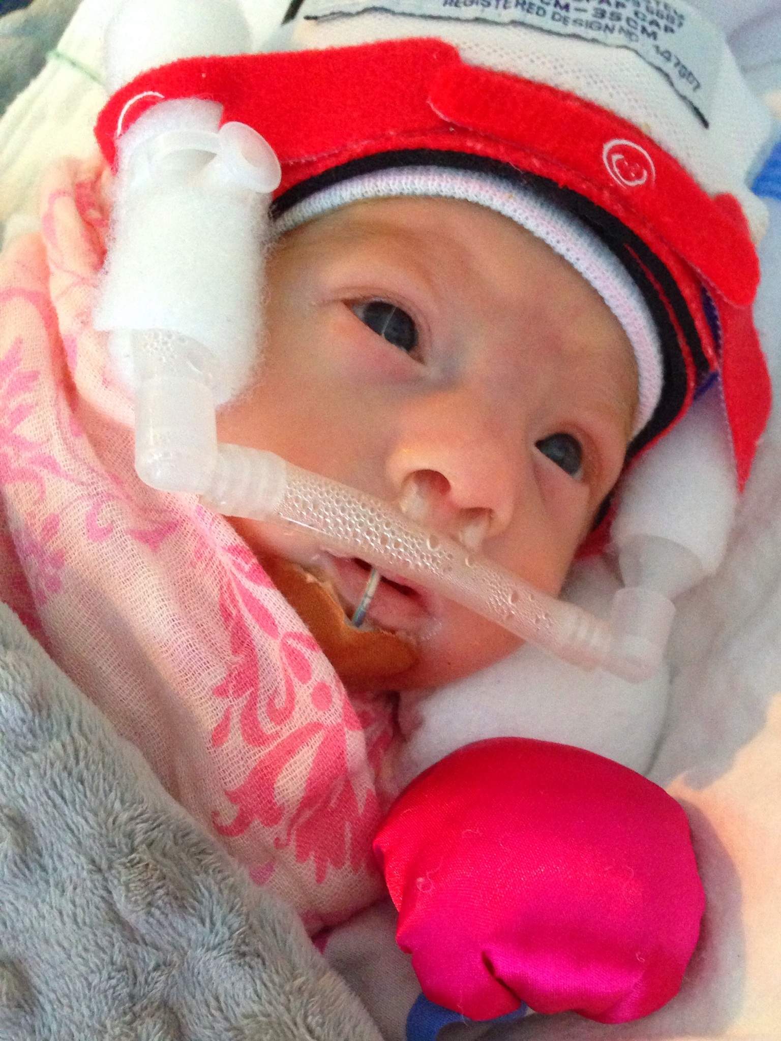 Treatment breakthrough could help premature babies with chronic lung ...