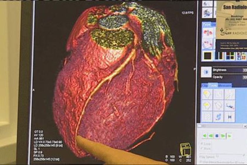 Stem cells give new hope to heart attack survivors - ABC News