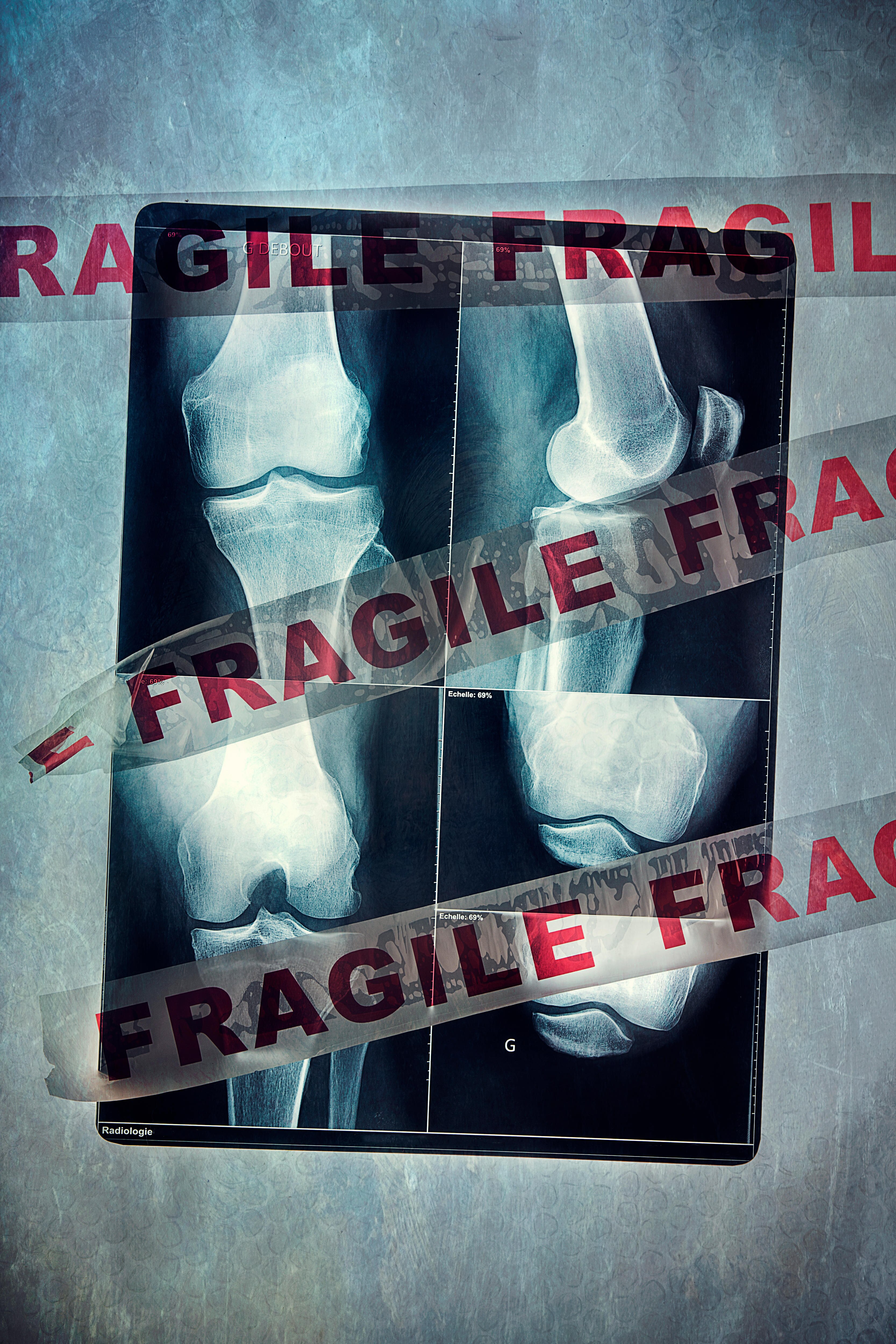 'Life is a box marked fragile' Loretta Smith on living with brittle ...