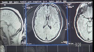 Breakthrough brain scans could aid mental health treatment: researchers ...