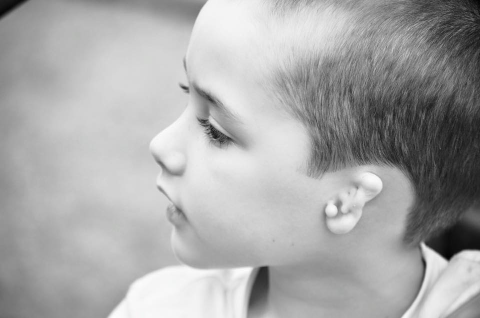 Boy born without outer ear, ear canal receives reconstructive surgery ...