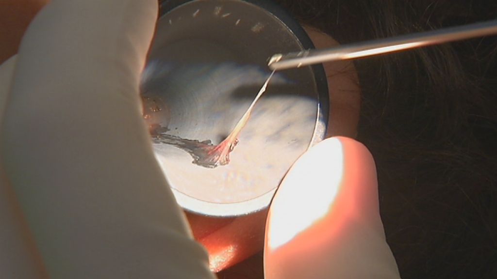 Glue Ear - Topic - ABC News