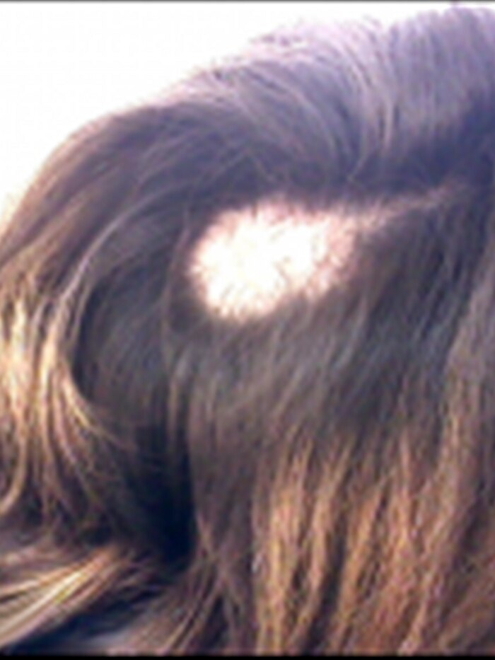 Researchers trying to solve mystery of compulsive hair pulling - ABC Radio