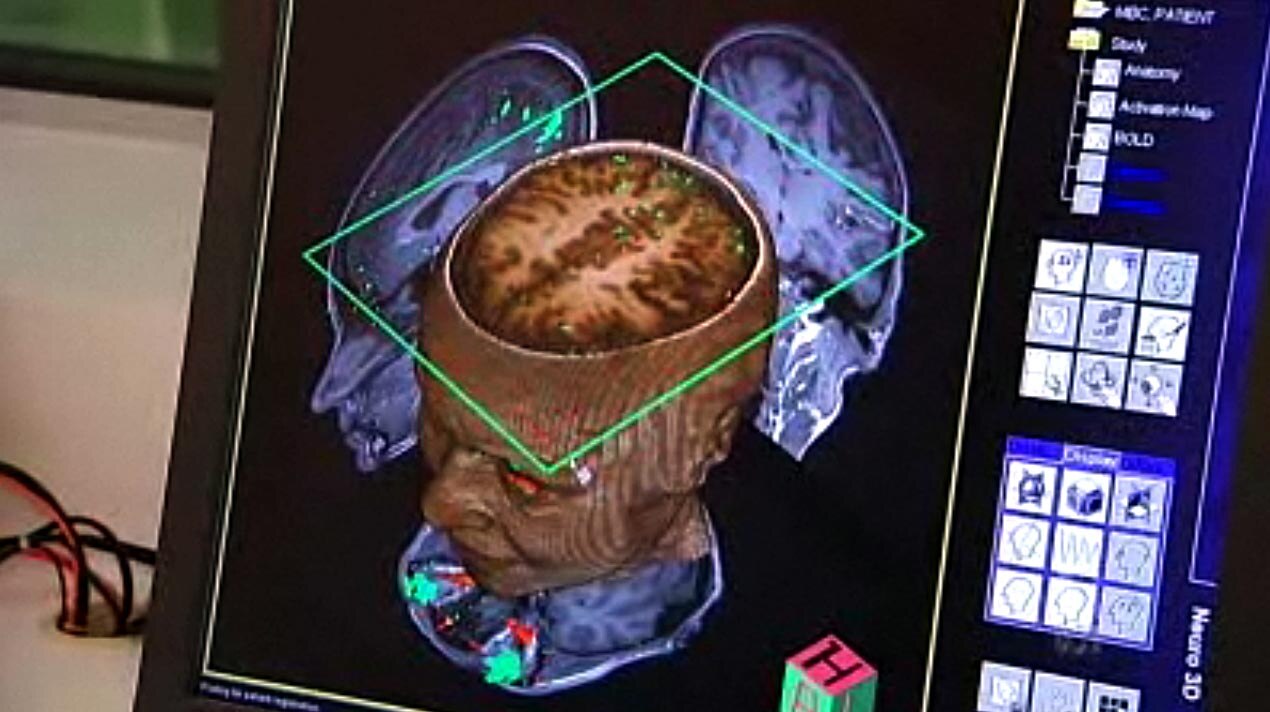 Australian researchers find epilepsy gene - ABC News