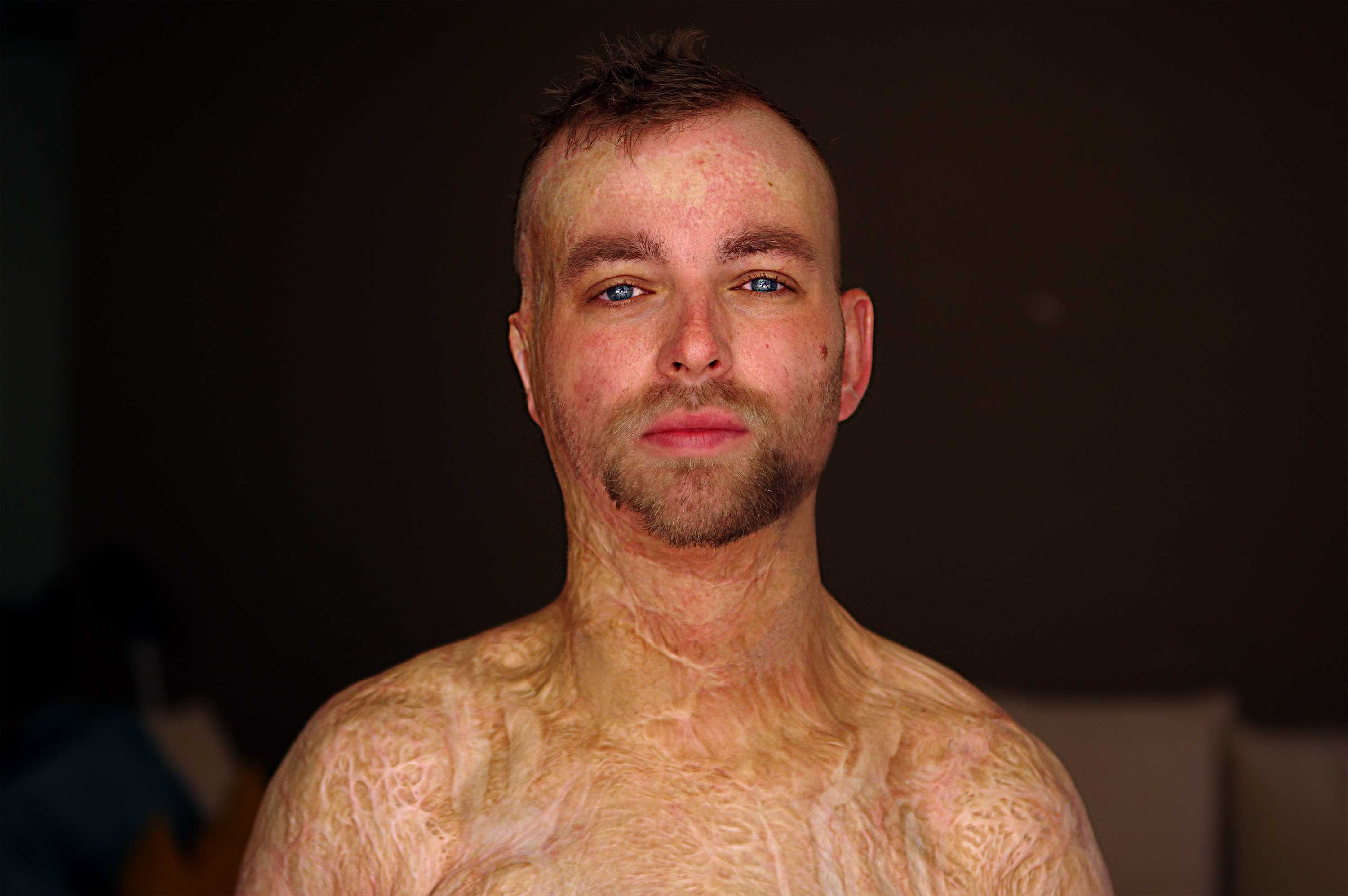 Ben Smith's horrific burns injuries now serve to warn children of the ...