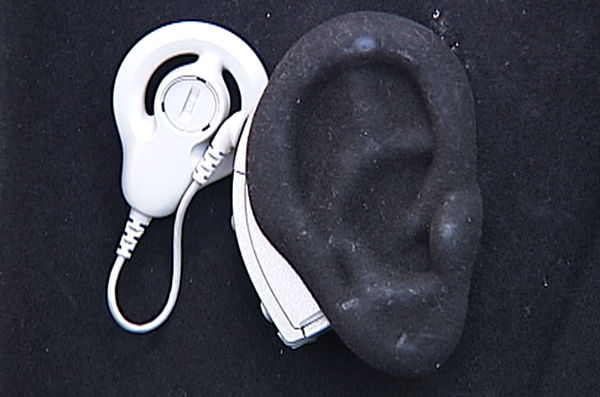 Pioneering cochlear surgeon reunites with patient 20 years on - ABC listen