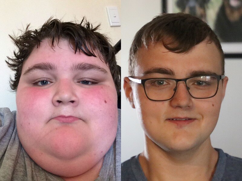 Why teens are resorting to drastic weight loss surgery to combat ...