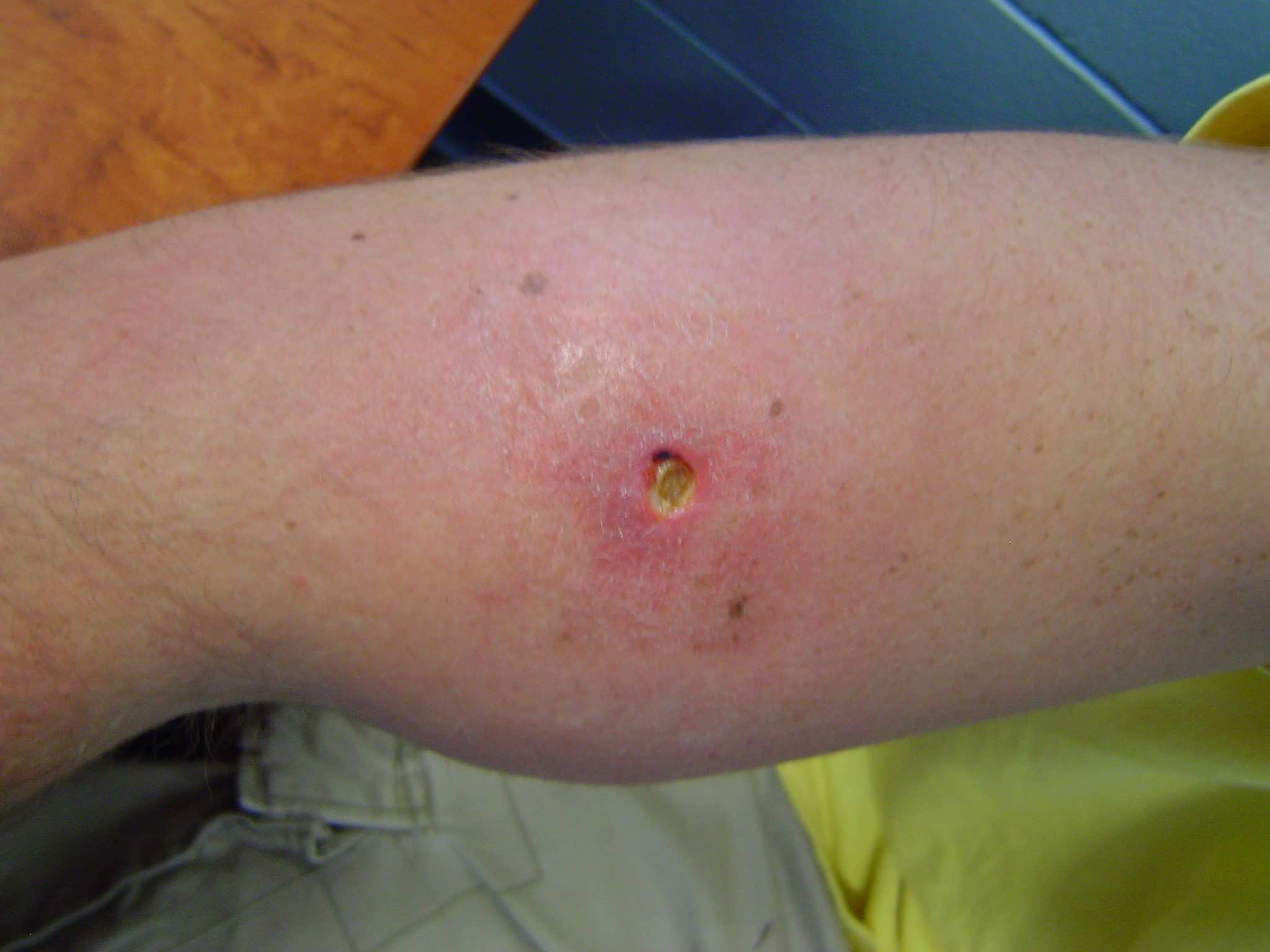 'Debilitating' flesh-eating ulcers on the rise, health experts warn ...