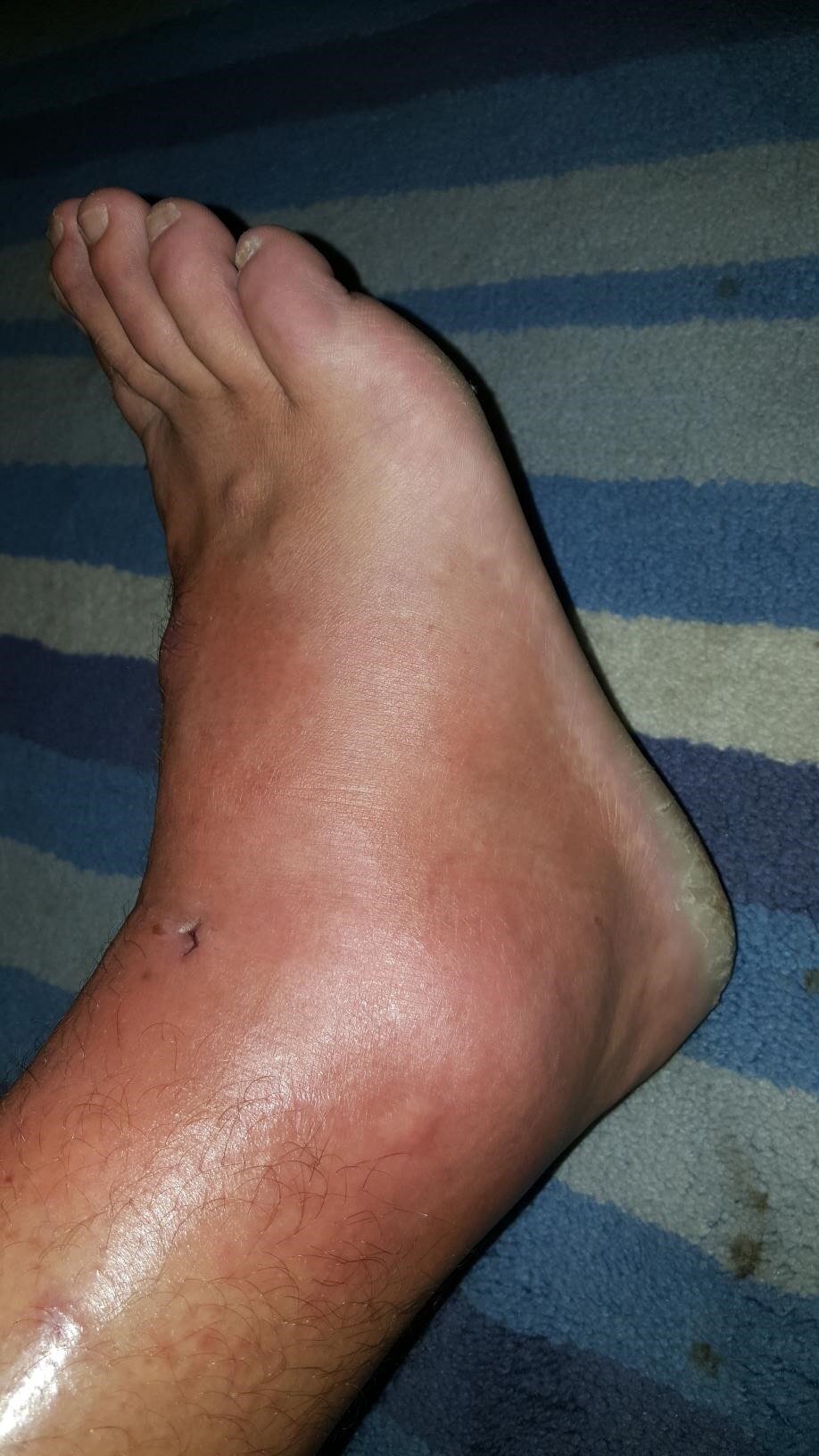 Perth man almost loses foot after stepping on stingray, says pain was ...