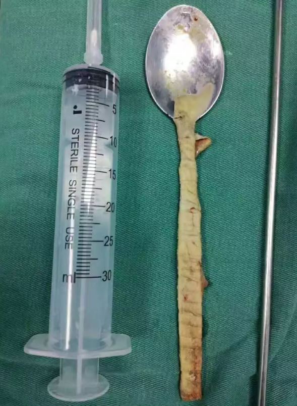 Chinese doctors remove spoon from man's throat one year after he ...