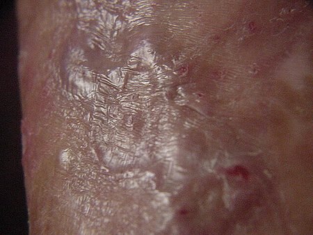 New treatment for burns patients - ABC News