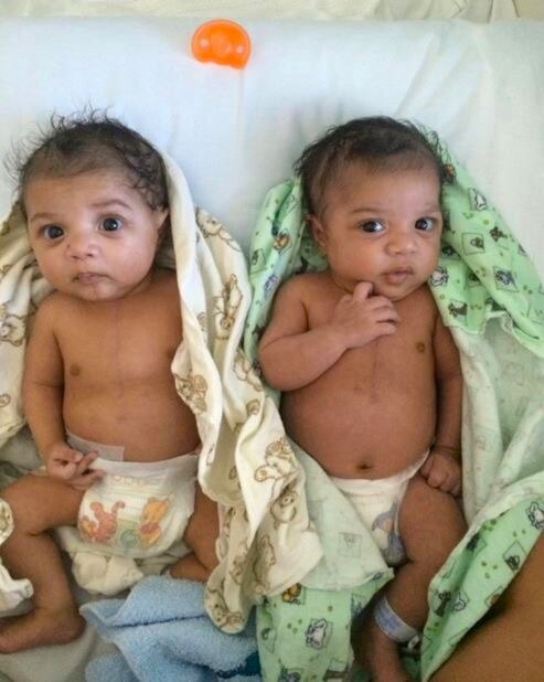 Twins Benson, Albert Tass thrive after open heart surgery at Queensland ...