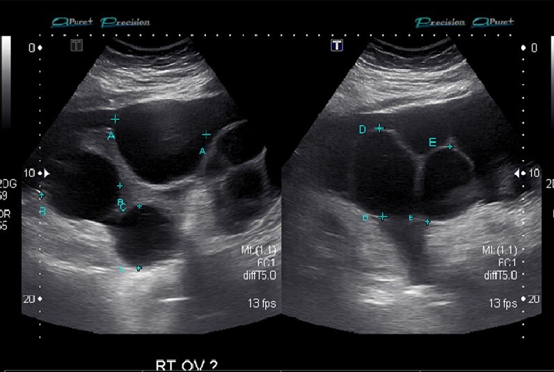 Ovarian Cyst And Cancer Ultrasound