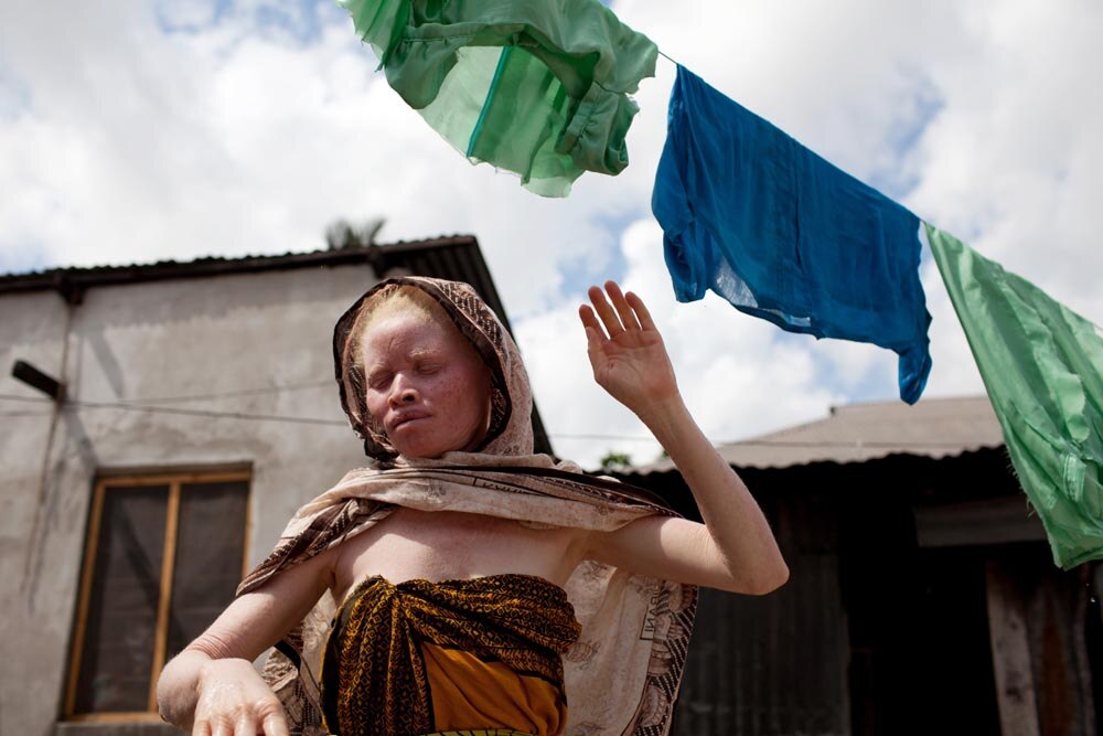 Hunted, stereotyped and misunderstood: living with albinism - ABC Radio ...