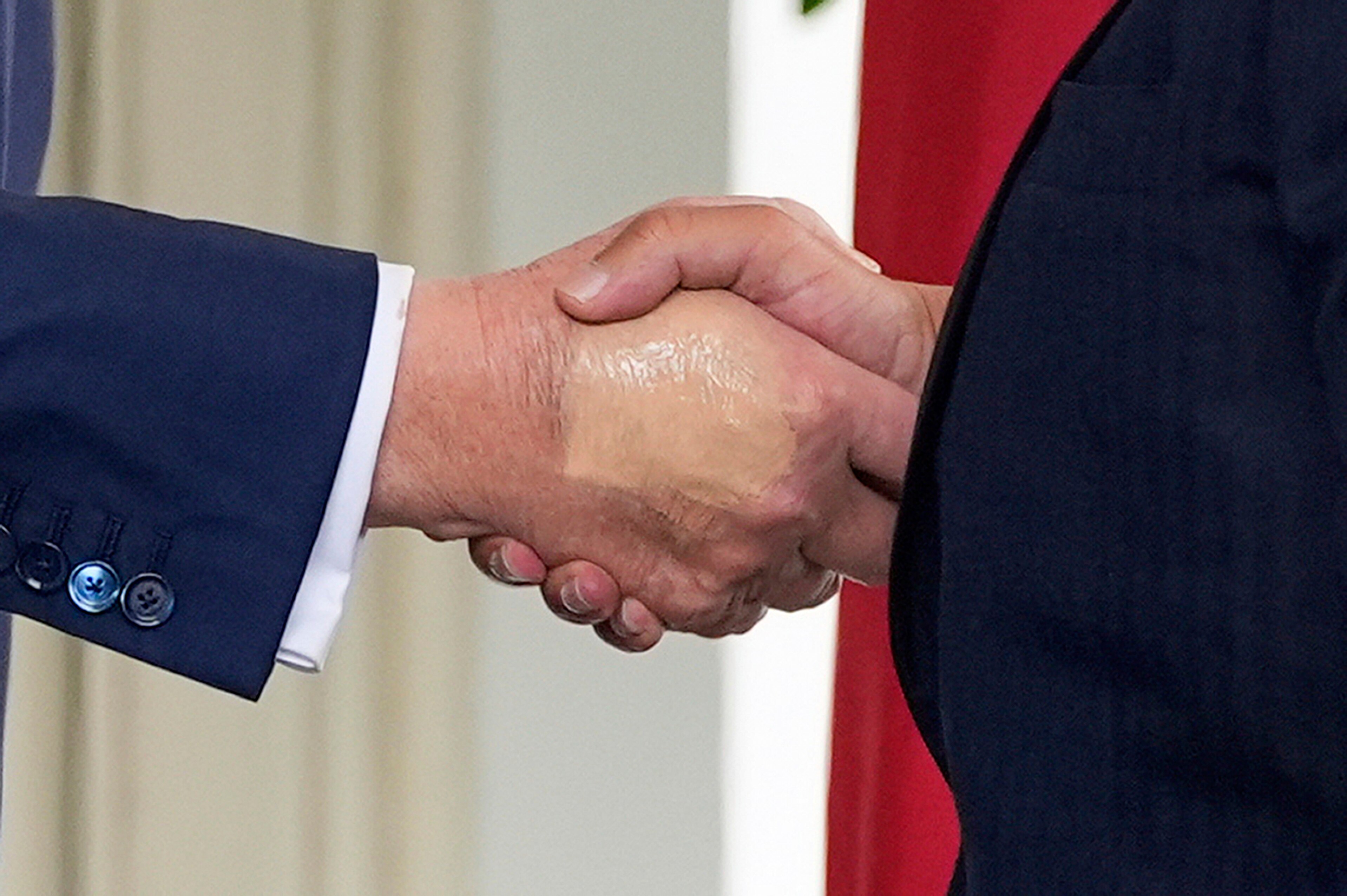 Donald Trump diagnosed with vein condition that causes leg swelling ...