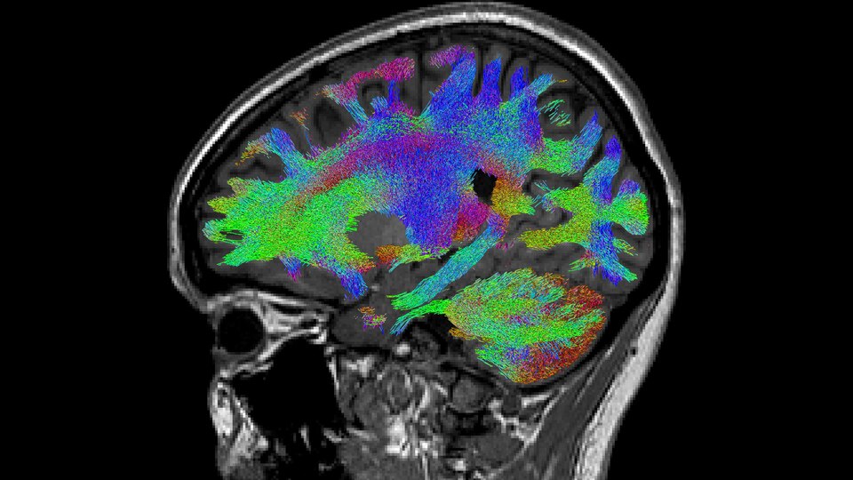 Tractography imaging creates beautiful 'brainbows' that are helping ...