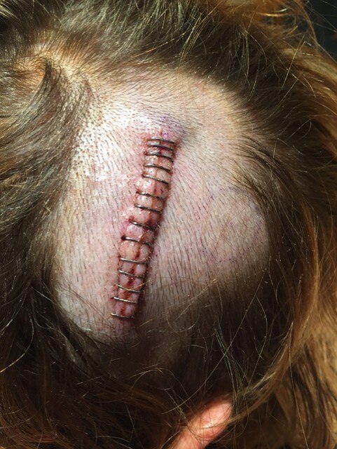 Remembering Charlie, and all the others lost to brain cancer, at the ...