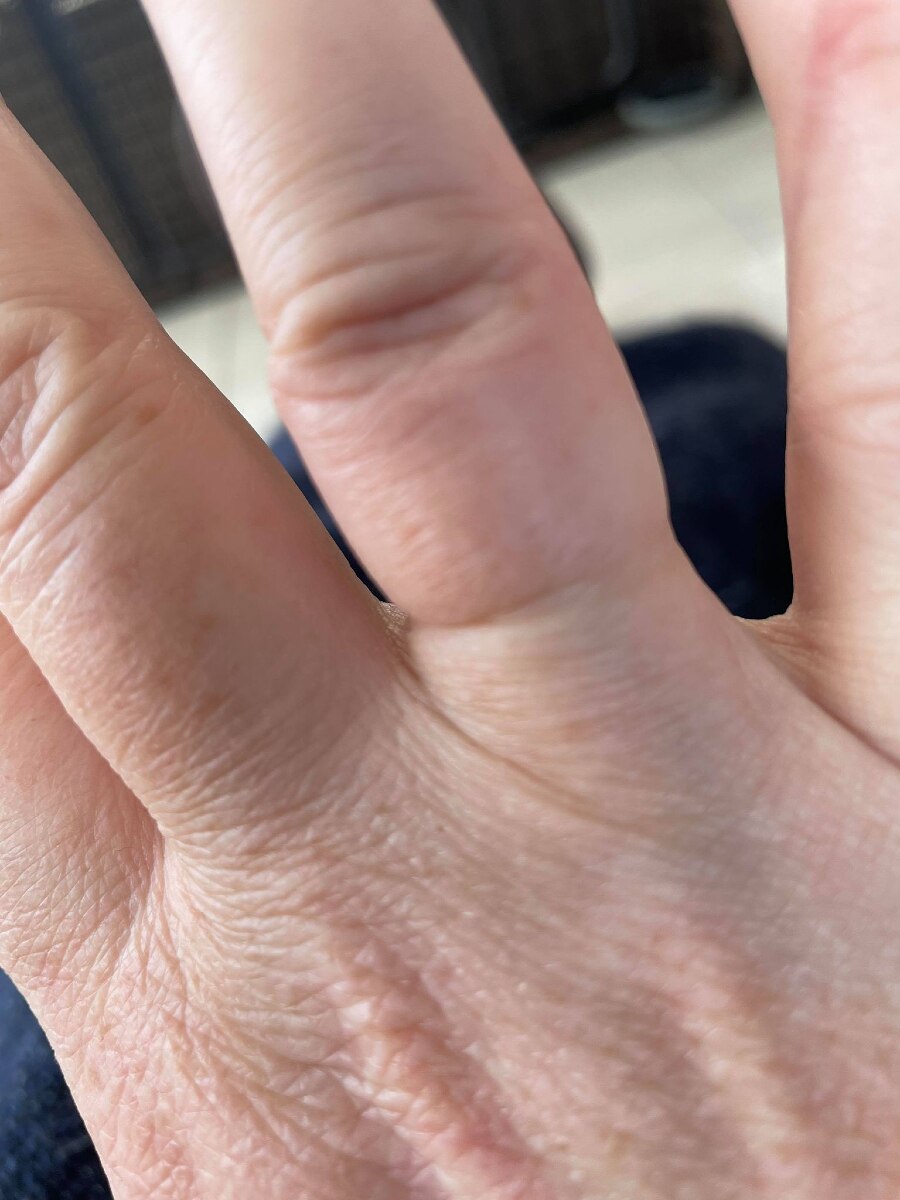 Stuck ring comes off with dental floss after finger goes 'purple and ...