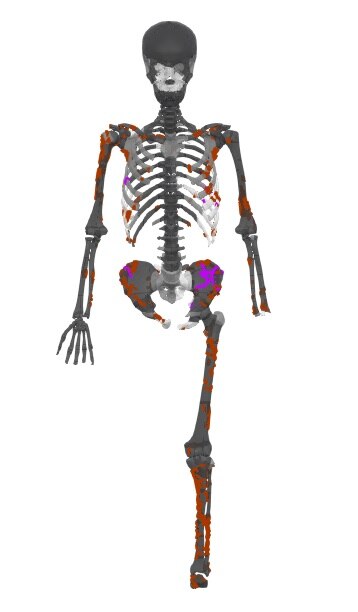 Researchers uncover remains of 3,000-year-old shark attack victim in ...