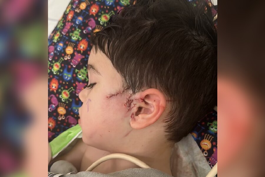 Four-year-old boy left with 'horrific' facial injuries after mauling by ...