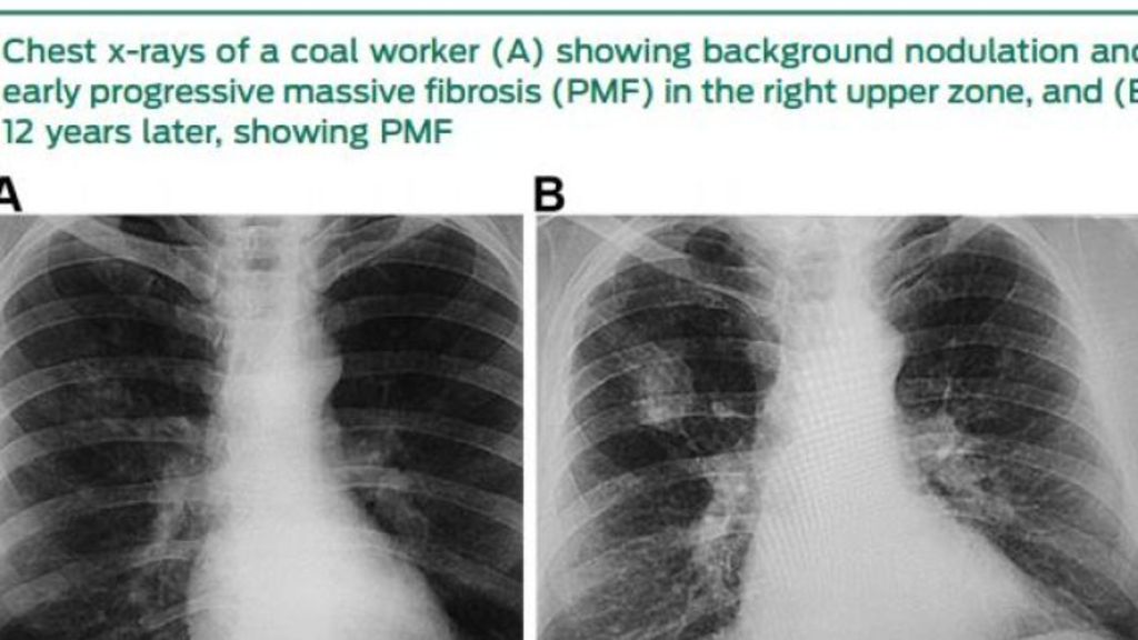 Workers compensation claims show black lung cases - ABC News