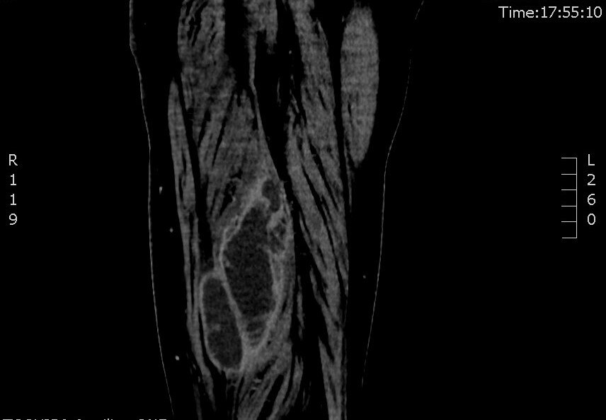 Difficult to diagnose and potentially deadly — this lesser-known ...