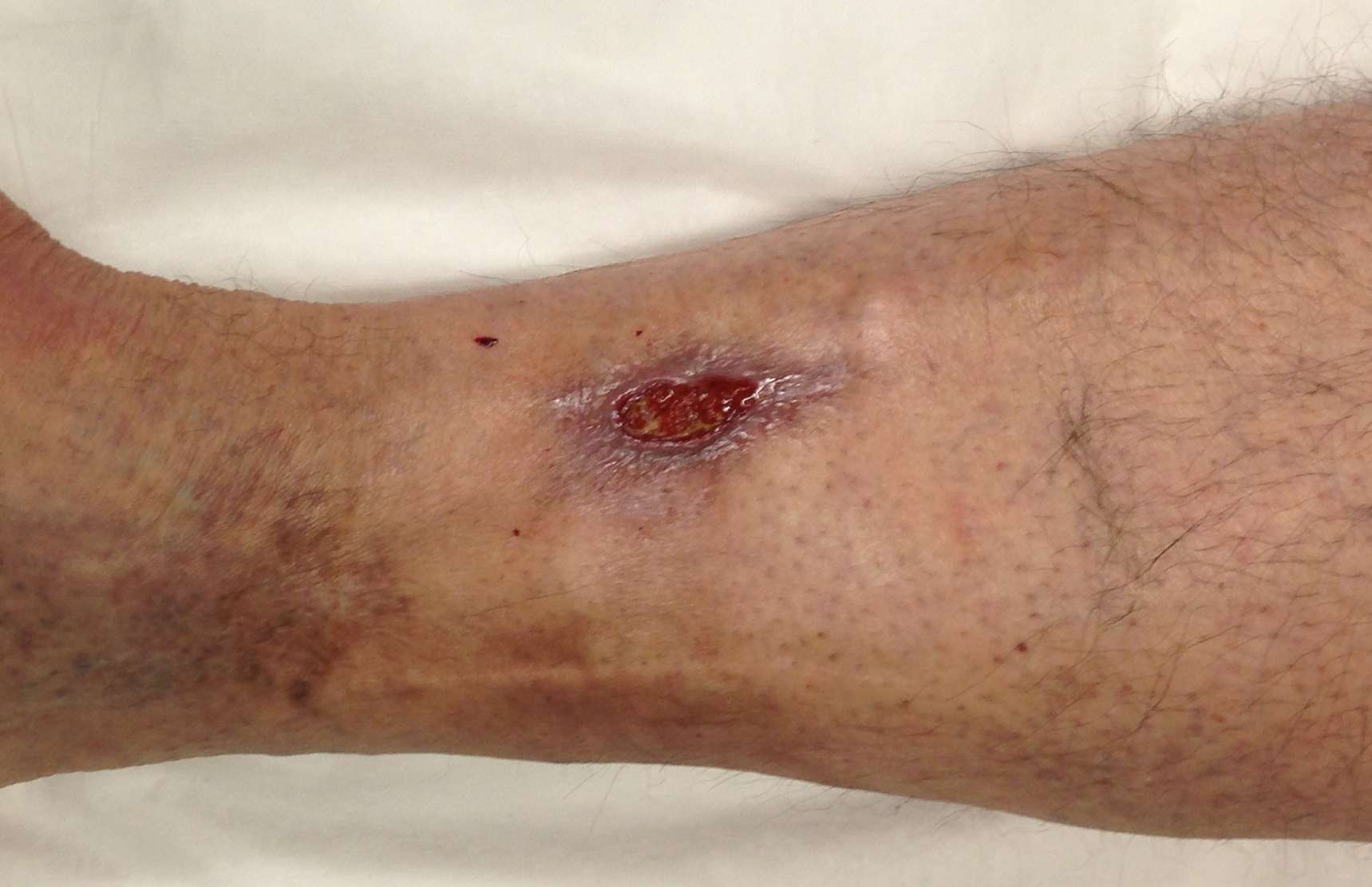 Understanding self-treatment of chronic wounds for faster healing ...