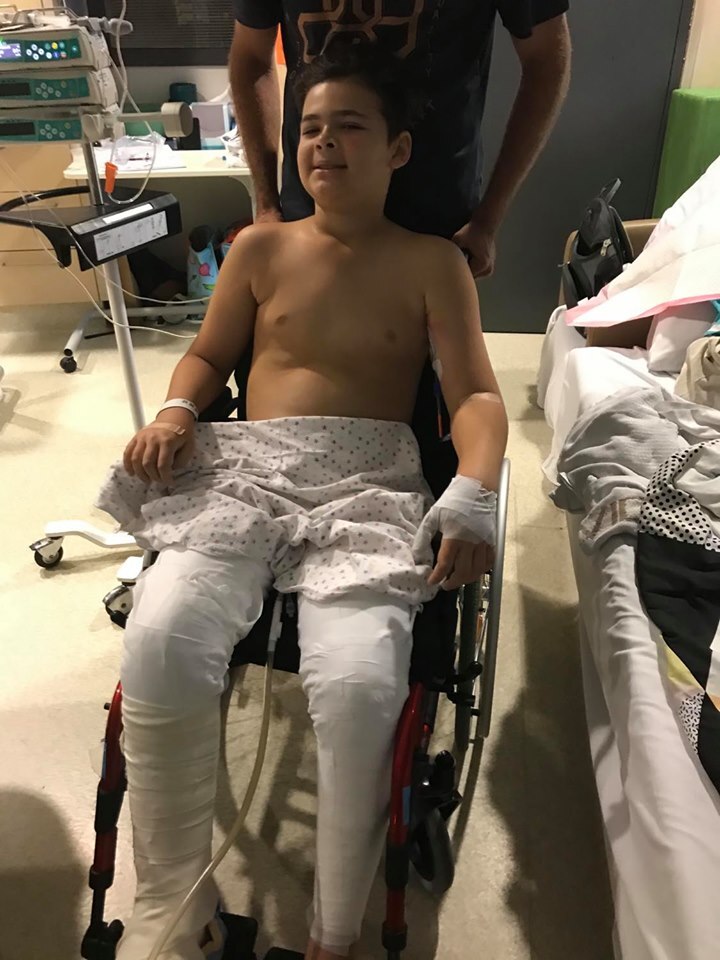 Campfire warning after boy severely burned by smouldering ash - ABC News