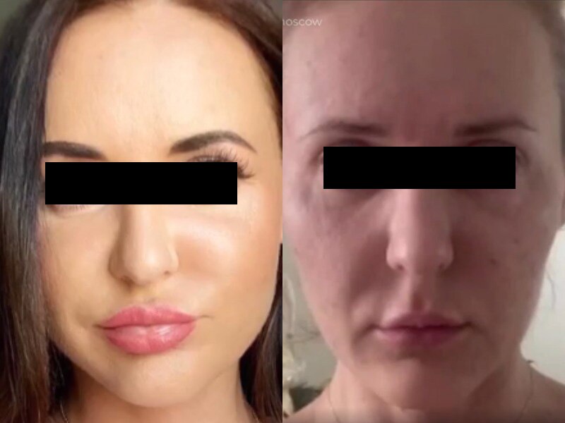Patients report side effects after popular cosmetic procedure to ...