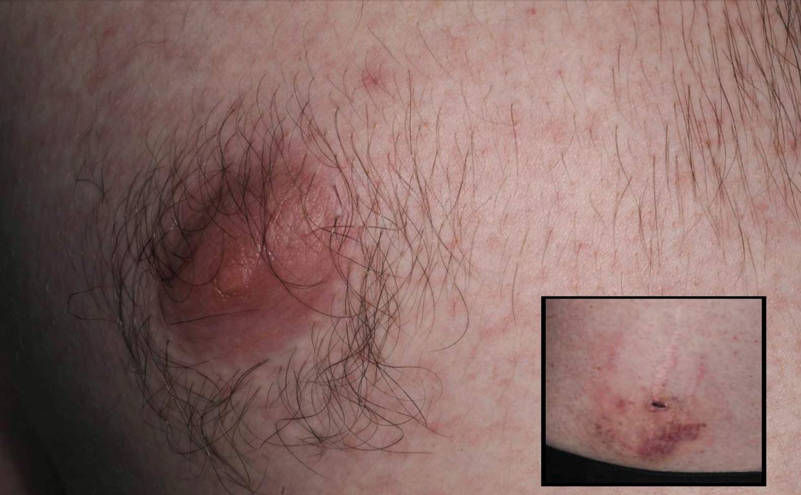 Zika victim bitten by Bali monkey recalls Dengue-like symptoms - ABC News