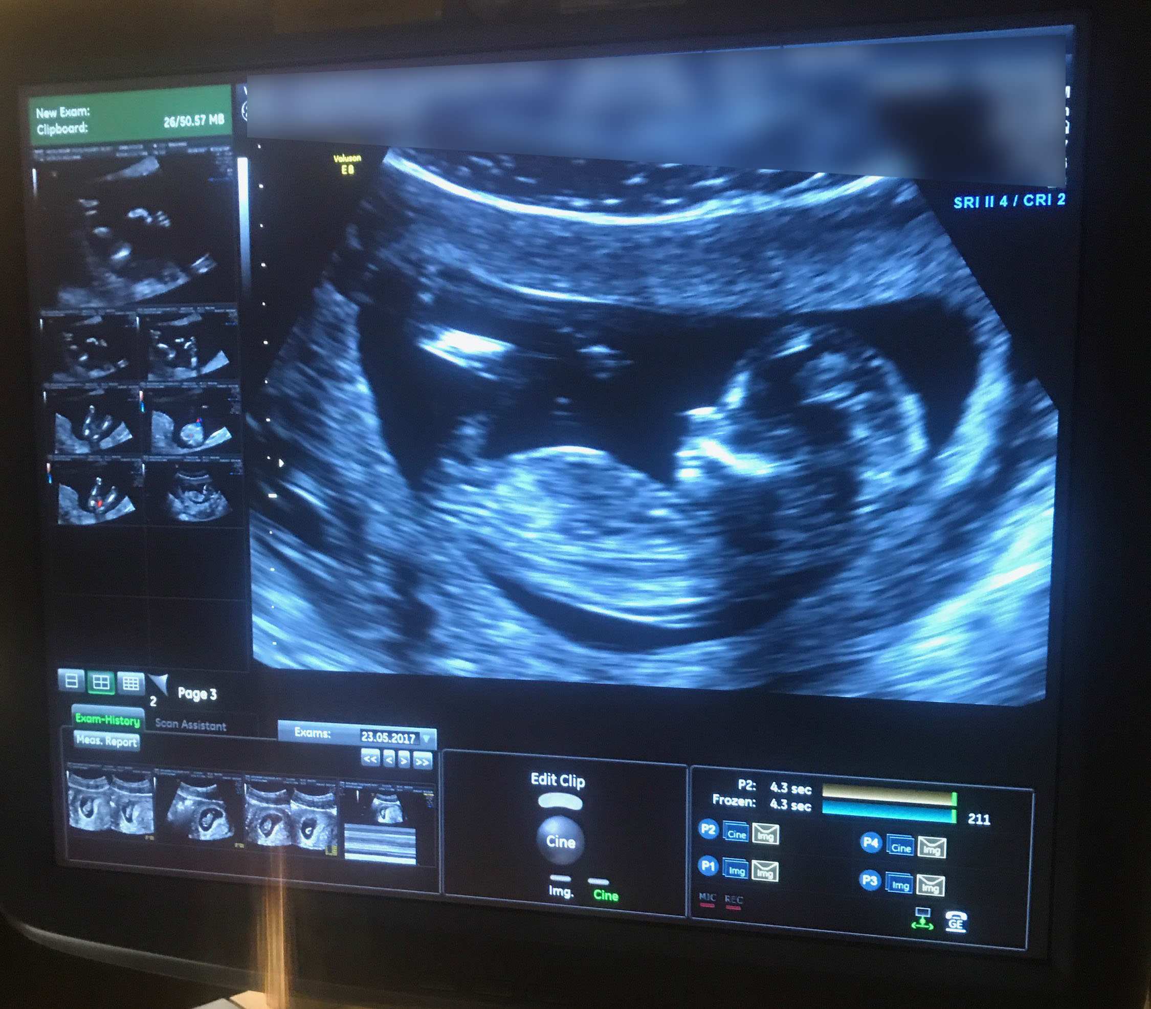 HPV screening: What started as shocking news after a Pap smear, ended ...