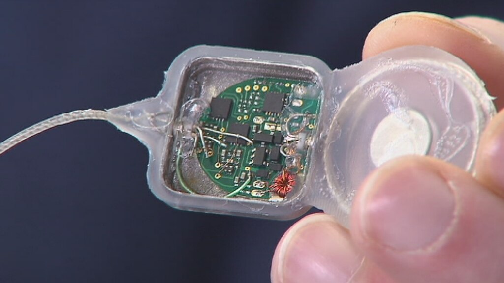 'Fit bit for the brain' that tracks epileptic seizures potential game ...